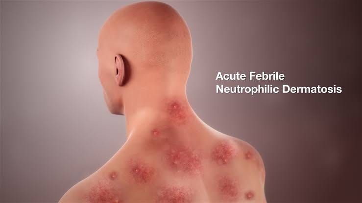 Sweet’s syndrome | by Muhammad Zubair | Medium