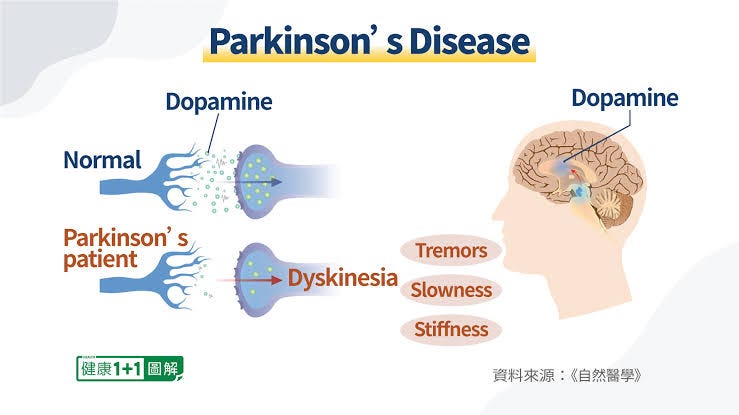 Understanding Parkinson’s “Off” Episodes | by Nirav Shah | Oct, 2024 ...
