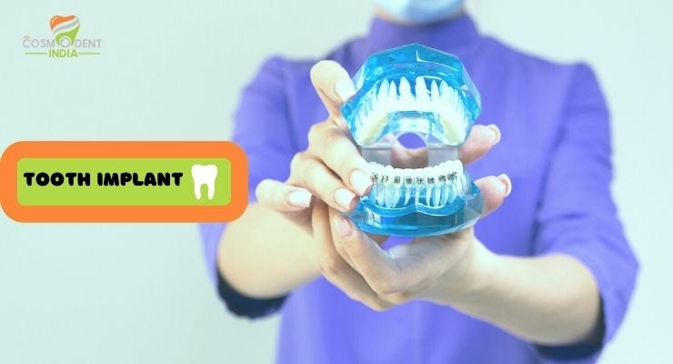 Cost of Permanent Teeth Transplant in India - Cosmodent India - Medium