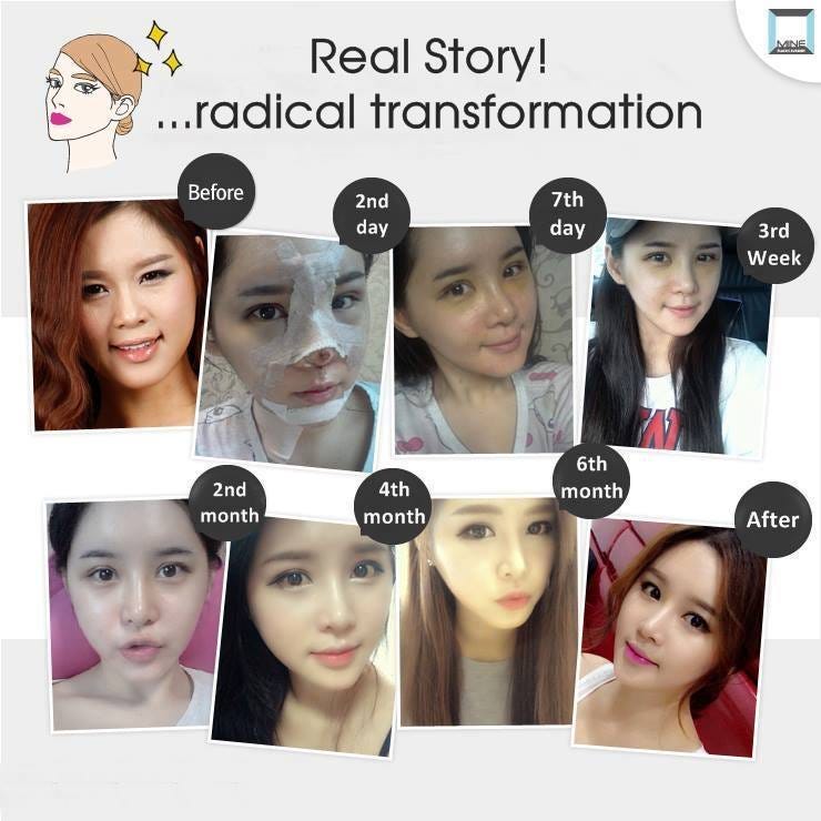 Take A Look At Dimple Surgery Before And After Photos And Go In For ...