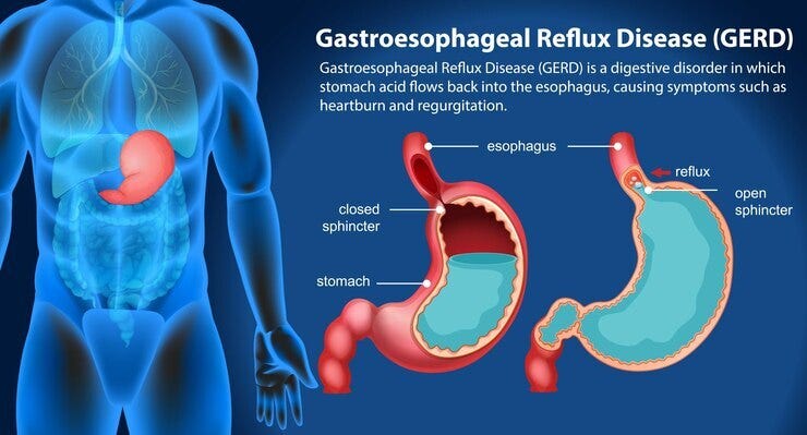 Understanding Acid Reflux: Causes, Symptoms, and Treatment Options | by ...
