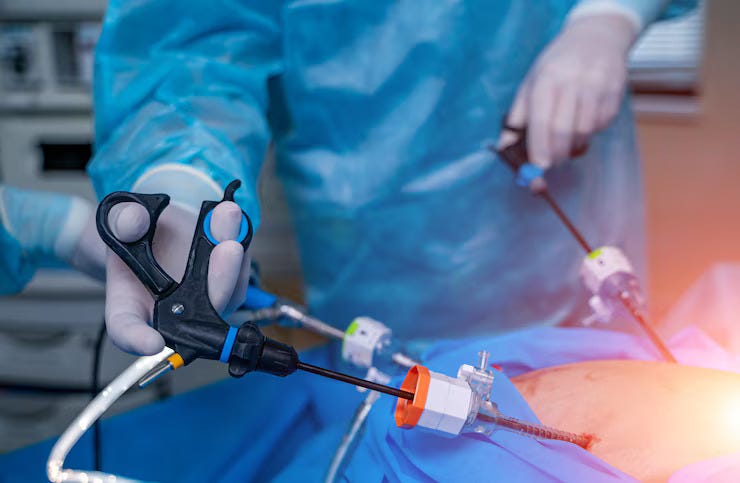 What are the benefits of laparoscopic cholecystectomy? | by Laparoscopy ...