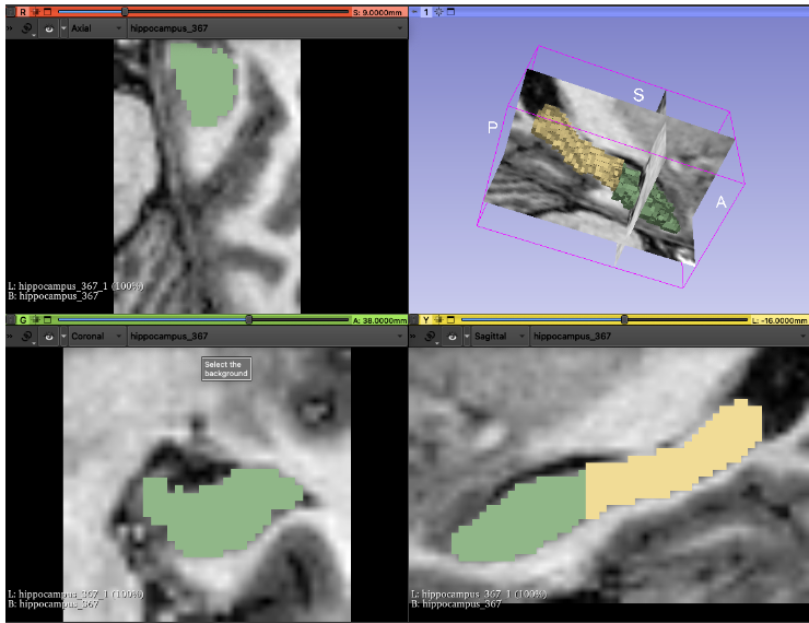 3D Computer Vision) Quantifying Hippocampus Volume for Alzheimer’s Progression | by Hanna Lee ...