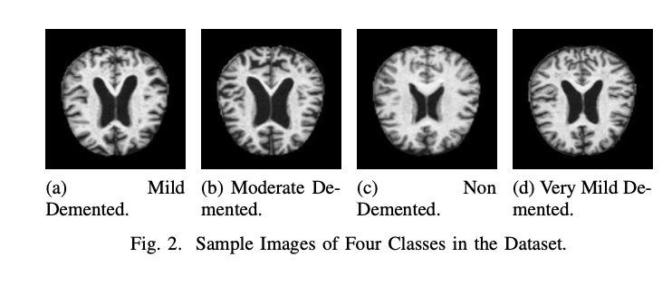 Using Machine Learning to Classify Alzheimer’s Disease Severity from ...