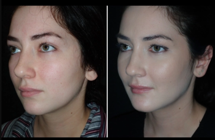 The Evolution of Facial Fat Transfer Techniques | by Fat-Transfer ...