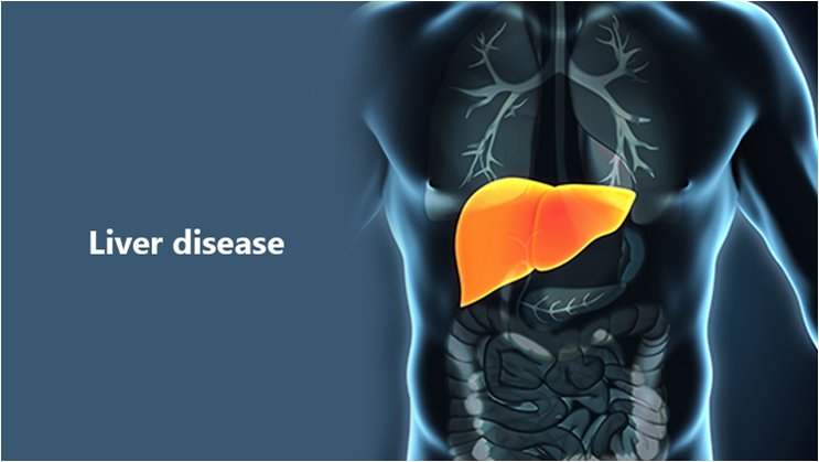 What is A MELD score and Why it Matters During Liver Transplant? | by ...