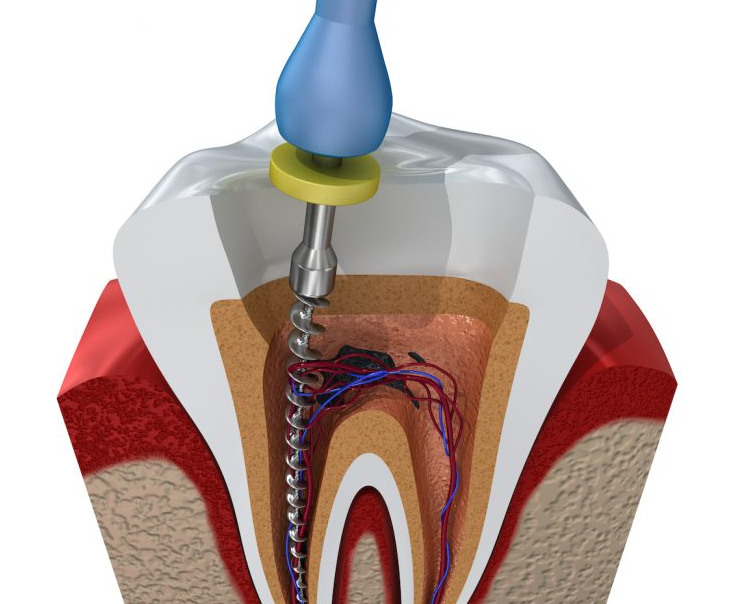 Root Canal Treatment Is A Dental Procedure Used To Treat An Infected Or ...