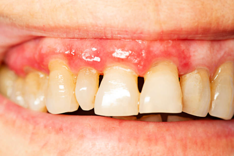 How Sugar Affects Your Teeth and Gums | by Leila Hariri Dental Clinic ...