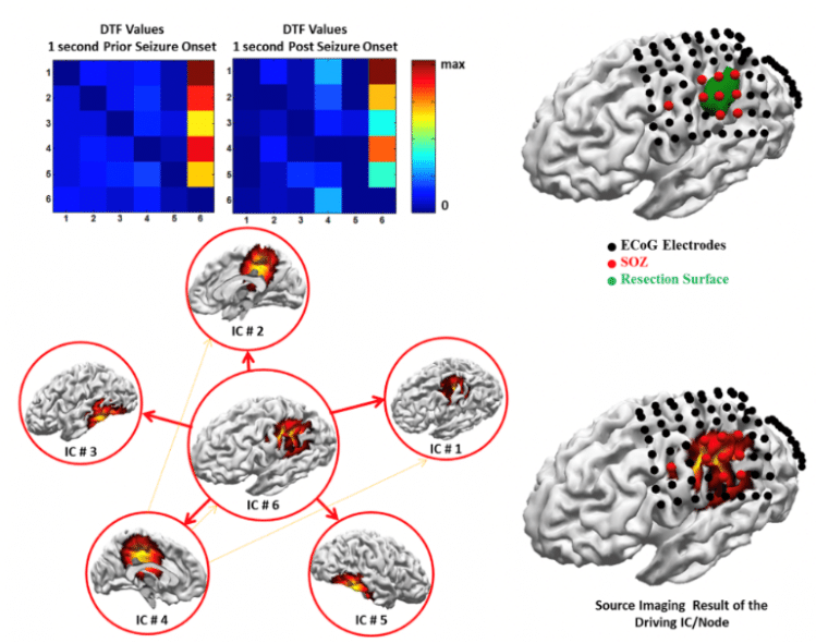 Epilepsy could be curable with the power of Brain-Computer Interfaces ...