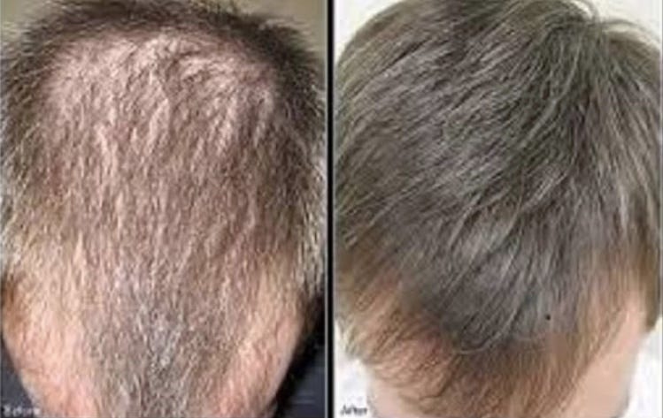 Watch Your Hair Come Back FASTER Than You EVER Dreamed Possible WITHOUT ...