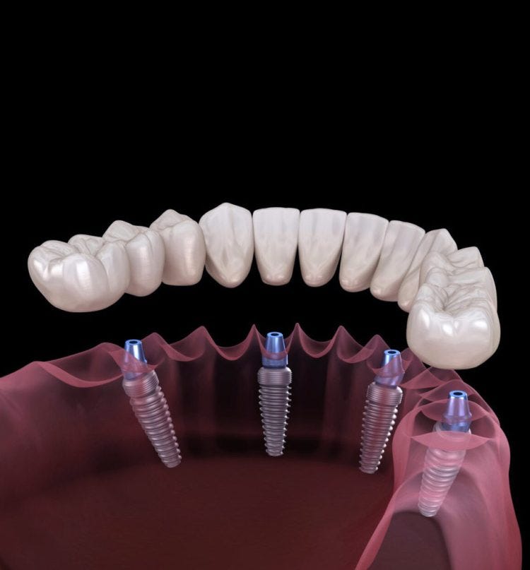 Best Dentures Implants Sydney Australia | by Sydney Dental Implant ...