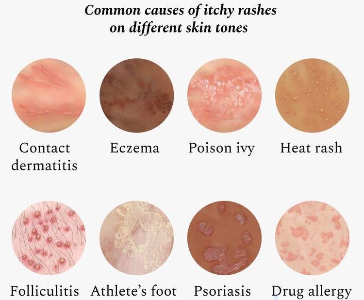 How Do Dermatologists Differentiate Between Different Types Of Rashes By Alok Hospital Medium