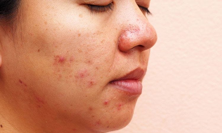 Severe Acne Remedy Myths busted. Understand that acne is something your ...