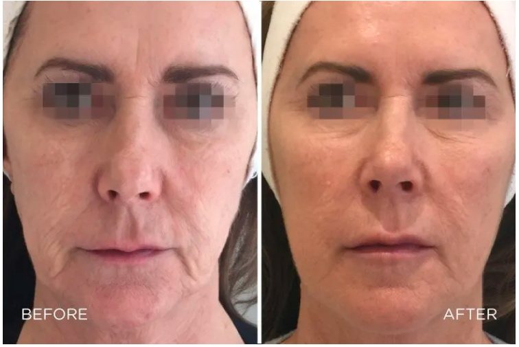 Profhilo Under Eyes Before and After: Achieving Youthful Transformation ...