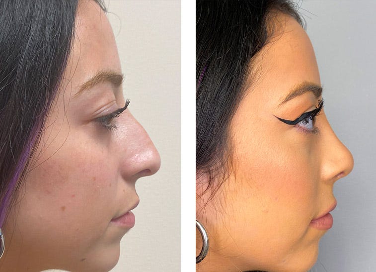 The Dubai Rhinoplasty Experience: Crafting Your Ideal Nose Shape | by ...