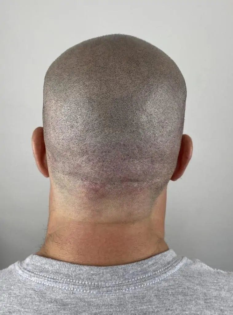 Everything You Need to Know About SMP Micropigmentation (SMP) | by ...