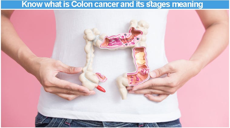 Know what is Colon cancer and its stages meaning | by Magnus Medi | Medium