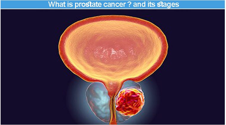 What is prostate cancer? and its stages | by Magnus Medi | Medium
