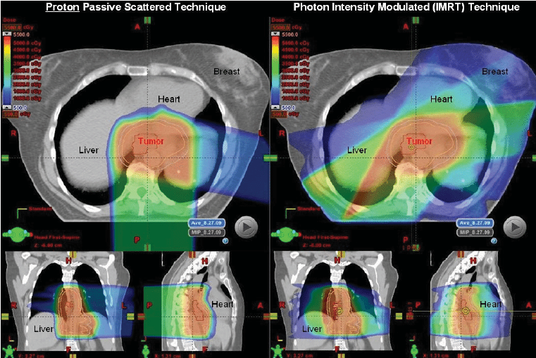 IMRT. IMRT is a treatment method that damages… | by Dem Ebs Backoffice ...