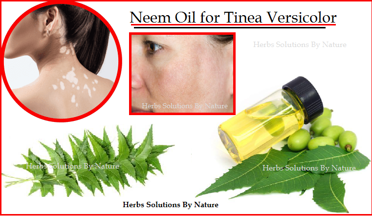 Neem Oil for Tinea Versicolor Natural Remedies and Natural Essential ...