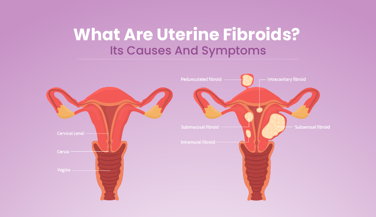 What are the treatment options for fibroids? | by Dr.Nisha Mangal | Jan ...