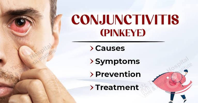 Conjunctivitis: Understanding, Prevention, and Treatment | by Rauf Awaan | Medium