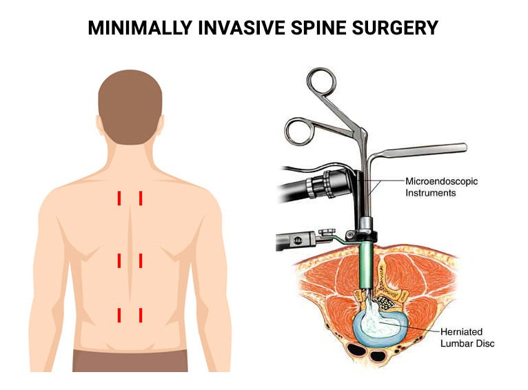 Minimally Invasive Spine Surgery: Advancements and Recovery | by Sanjana | Medium