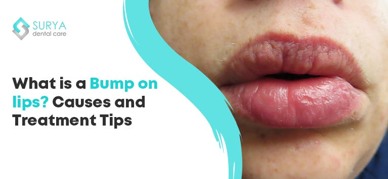 What Is A Bump On Lips Causes And Treatment Tips By Mihika Vasant Feb 2024 Medium