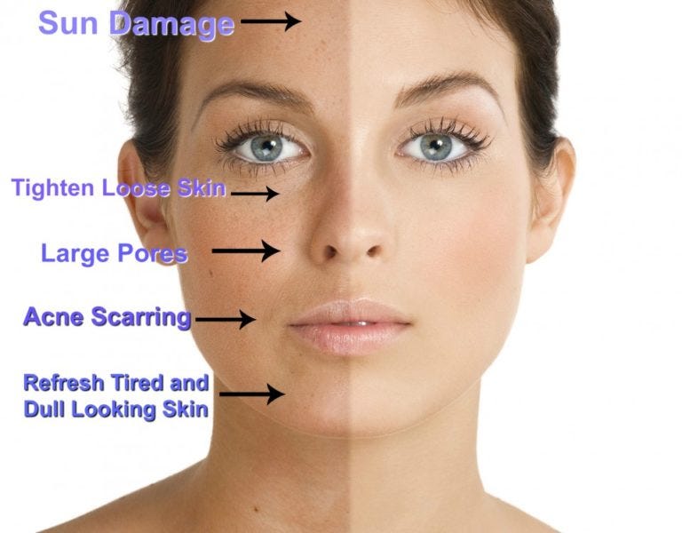Chemical Peel Treatment. Chemical peels control the damaged skin… | by ...