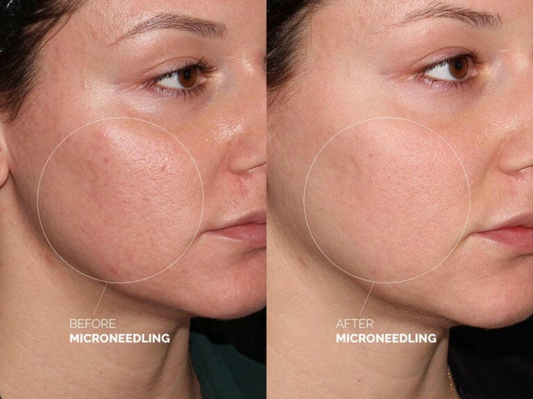 Microneedling for acne scars. The cosmetic procedure of microneedling ...