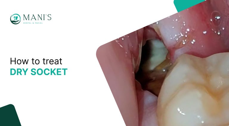 How to treat dry socket. A somewhat common, albeit unpleasant… | by Manisdental | Aug, 2024 | Medium
