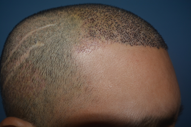The Risks of Hair Transplants - Jessica Cram - Medium