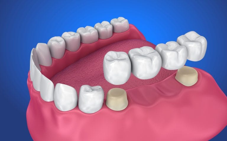 How Dentists Ensure Proper Fittings for Crowns? | by Venkateshwar ...