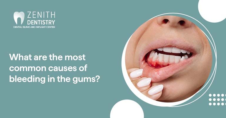 What are the most common causes of bleeding in the gums? | by Zenith ...