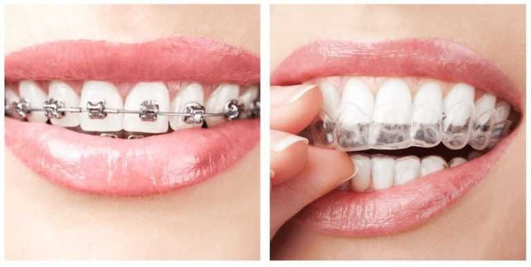 Clear Aligners v/s Braces. Which Orthodontic Treatment gives Faster ...