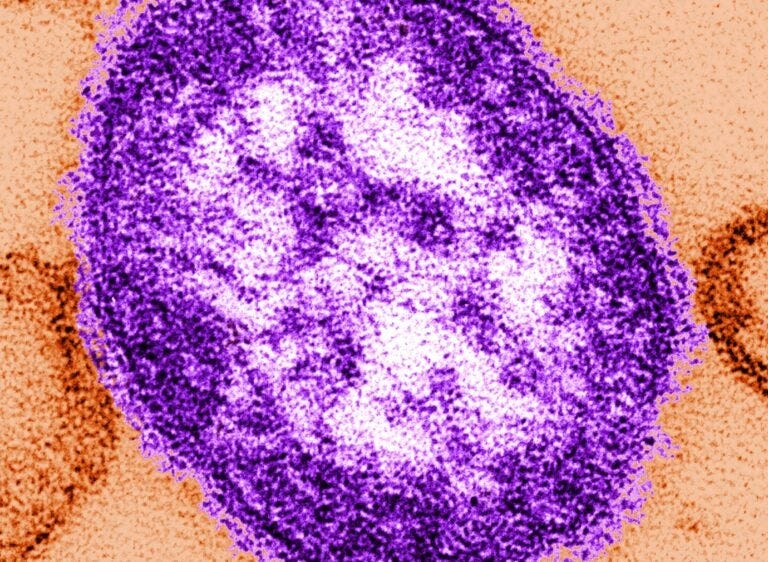 Measles confirmed in unvaccinated Montgomery County child; others may have been exposed | by Md ...