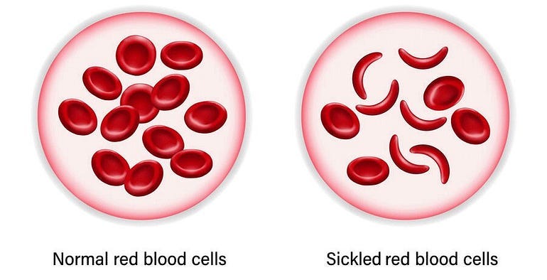 Sleep Disruption in Patients with Sickle Cell Anemia. | by Health Geek ...