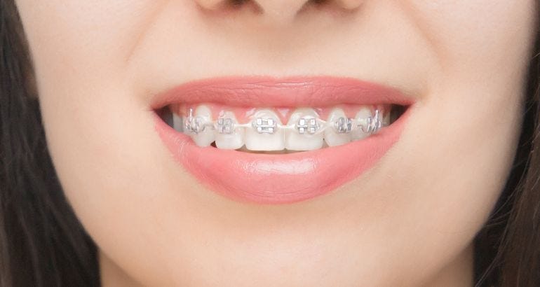 The Ultimate Guide to Braces Treatment in Chandigarh | by Sakshi lade ...