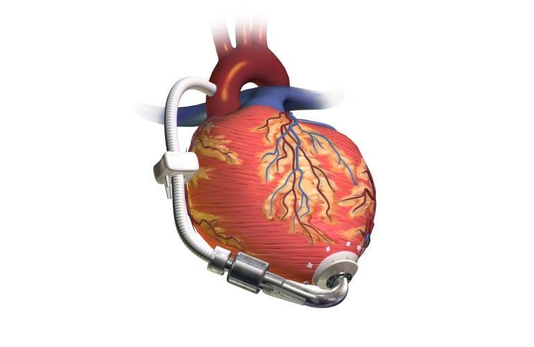 Cardiac Assist Devices (CADs) are Blood Pumps that Help very Unwell ...
