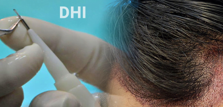 The DHI Hair Transplant’s Power. Unlike more conventional techniques ...
