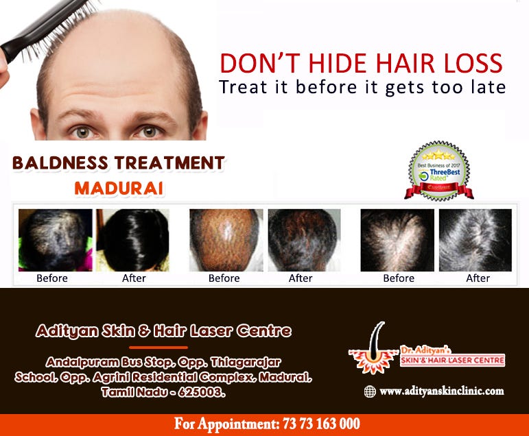 3 Major Reasons For Baldness And The Best Baldness Treatment Madurai ...