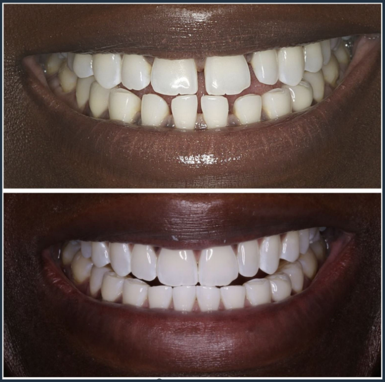 What Are Invisible Aligners?. Maintaining good oral health is crucial ...