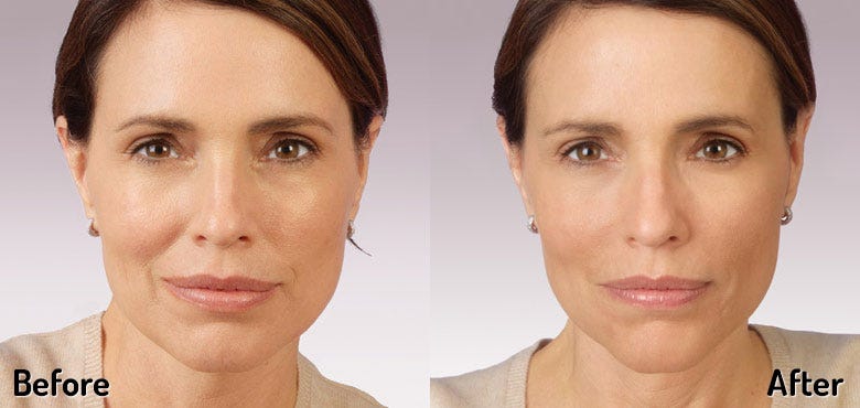 The Beauty of Cheek Fillers: Sydney’s Top Clinics | by Dental Aesthetic ...