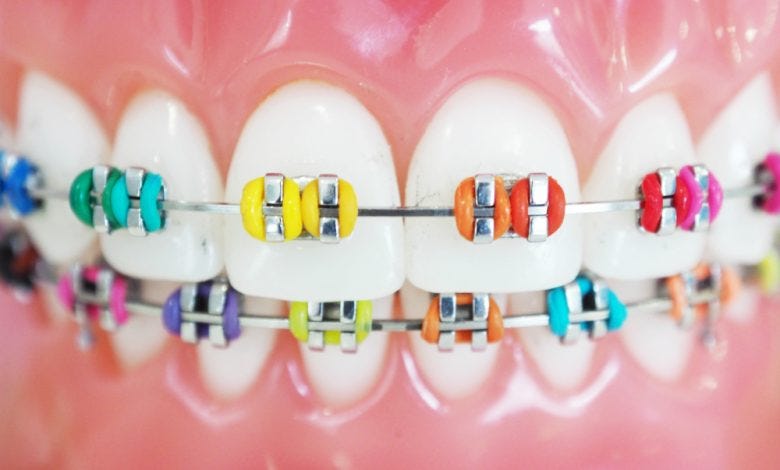 What color braces are most attractive? | by Waleed Gulzar Vines | Medium