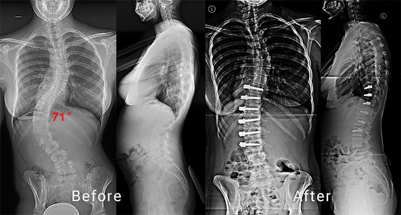 Benefits of Spinal Curvature Surgery in Dubai | by Adam Vital Hospital ...
