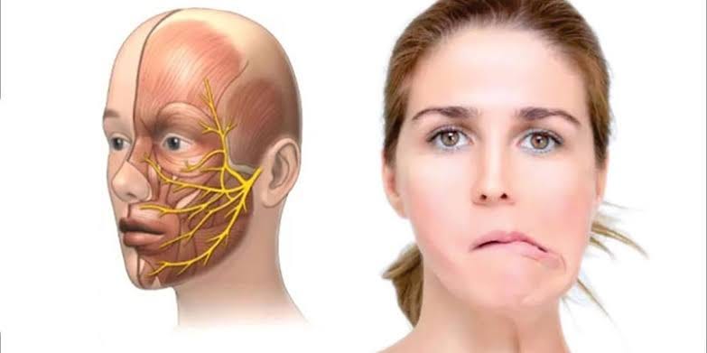 INTRODUCTION Facial nerve dysfunction can severely affect a patient's ...