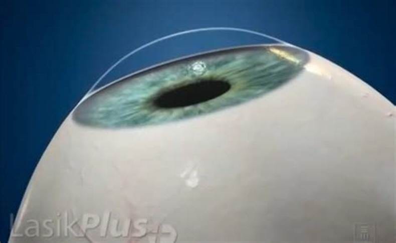 Is Silk Eye Procedure Dangerous?. In the ever-changing field of vision ...