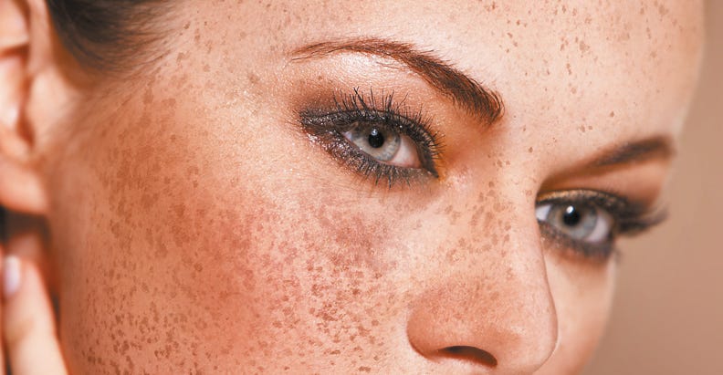 Guia Definitivo sobre Melasma: Entenda e Trate as Manchas Escuras na ...
