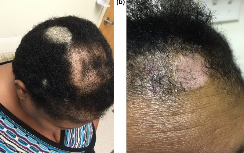What is Scalp Psoriasis And What Does it Look Like ? | by Tracy’s | Medium