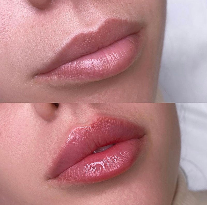 Needle-Free Lip Plump In Georgia | Derma Fuse | Laser Hair Removal In ...